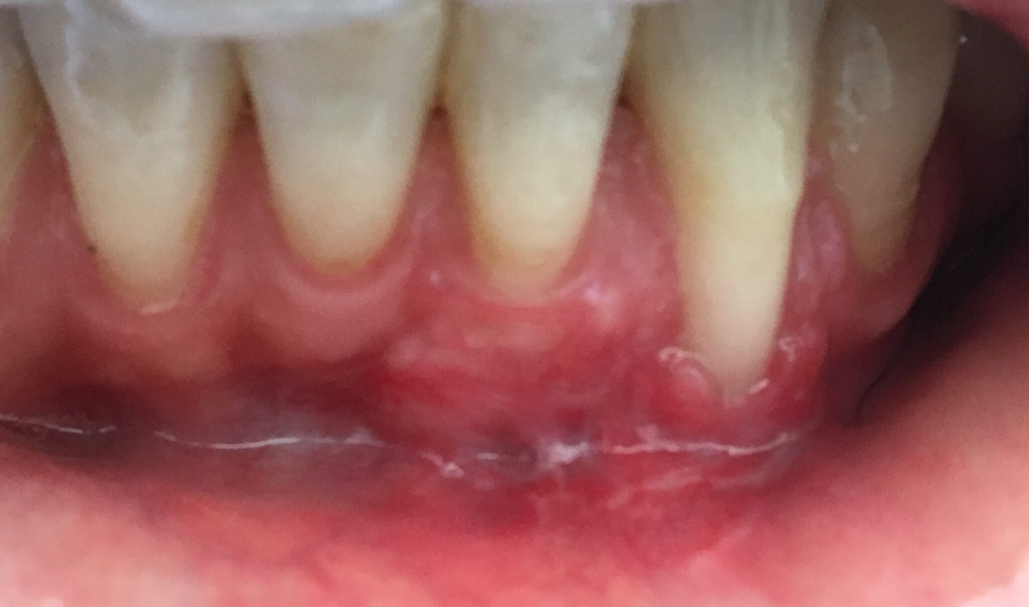 Tandkød er tilbagetrukket • For lang tand – Tandlæge Marianne Hoffmeyer