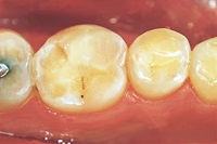 Acid damage • Erosion – Tandlæge Marianne Hoffmeyer