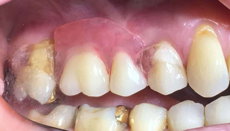 Delprotese • Helprotese – Tandlæge Marianne Hoffmeyer